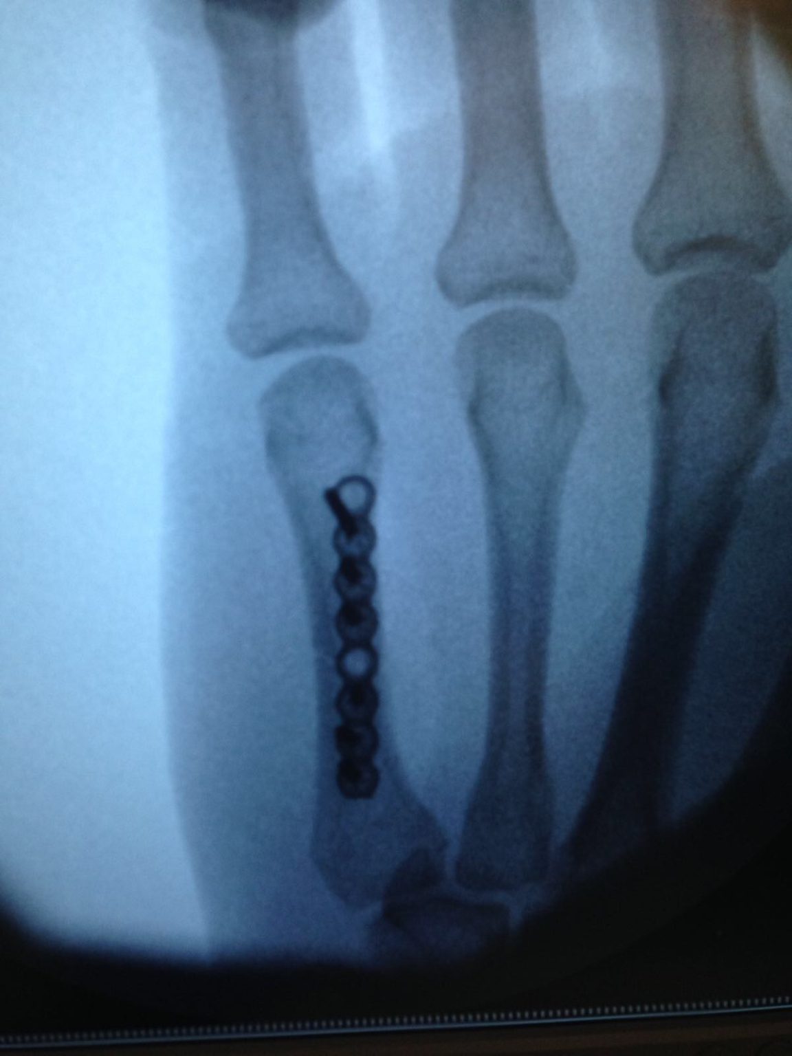 Fractures Of The Metacarpal Bones Zaf Naqui