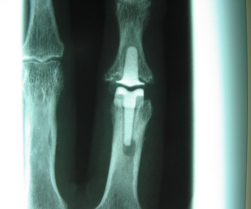 Arthritis in the fingers - Zaf Naqui