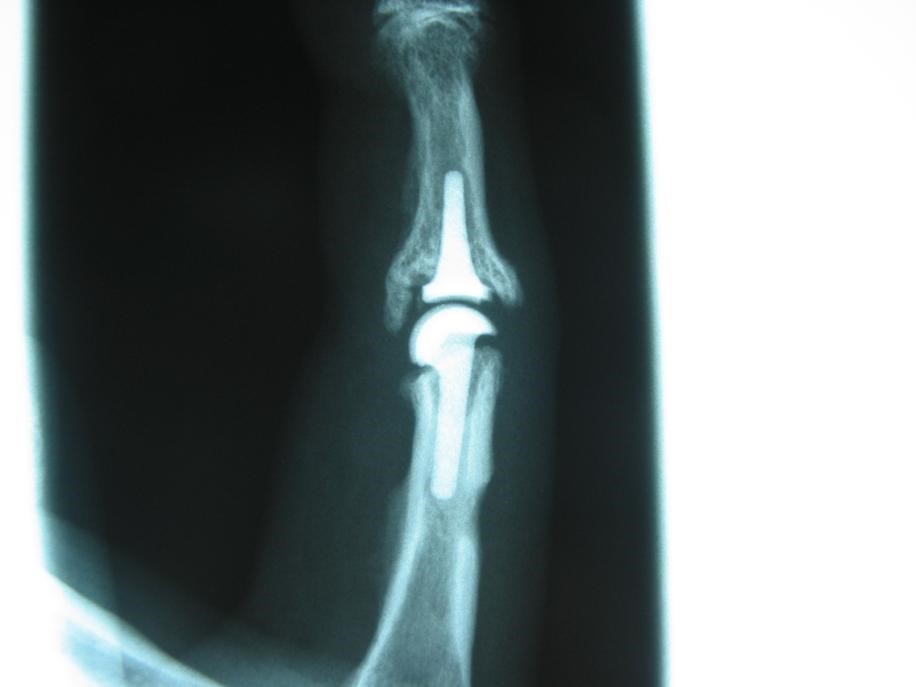 Joint replacement in the Hand and Wrist - Zaf Naqui