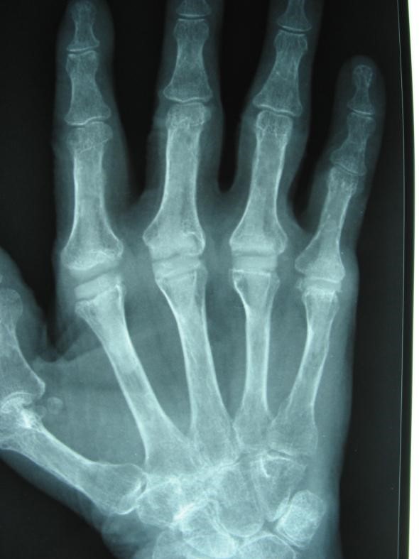 Joint replacement in the Hand and Wrist - Zaf Naqui