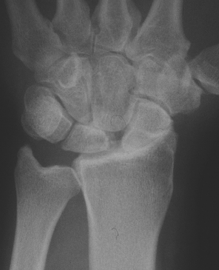 Wrist Arthritis / SLAC and SNAC - Zaf Naqui