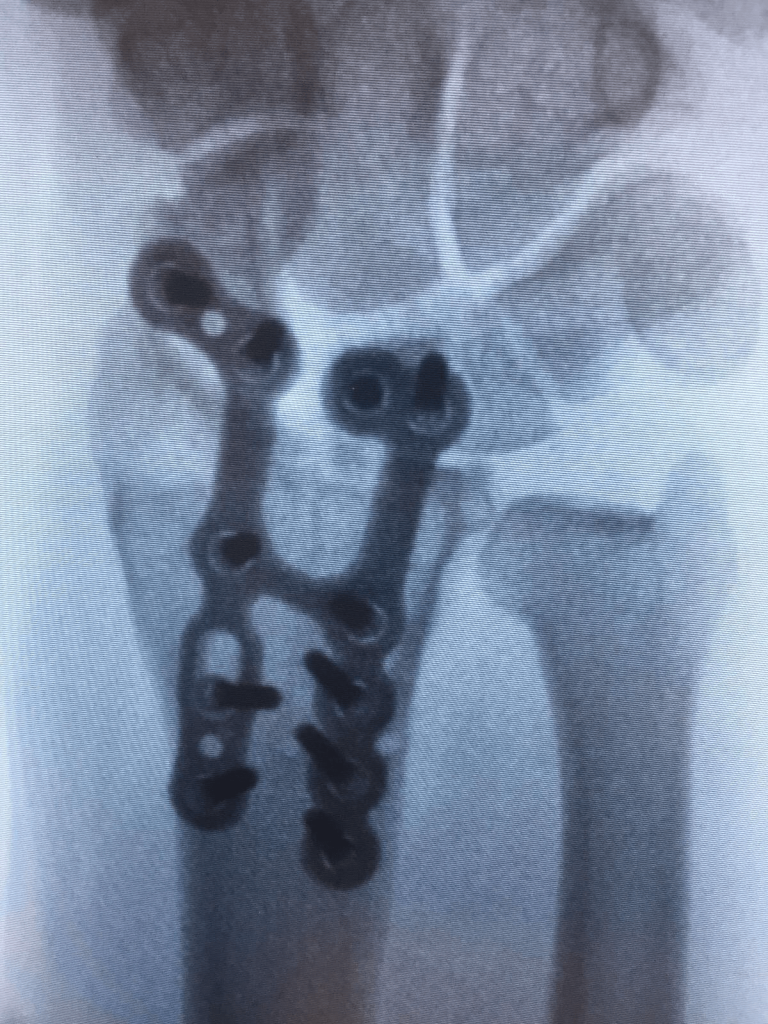Wrist Arthritis / SLAC and SNAC - Zaf Naqui